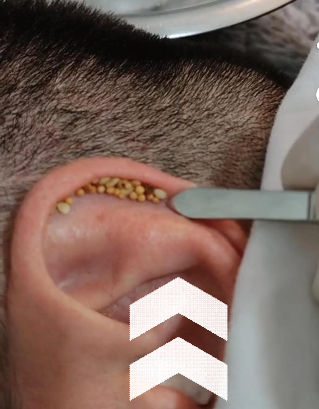 Story. Ears infection - Breaking News